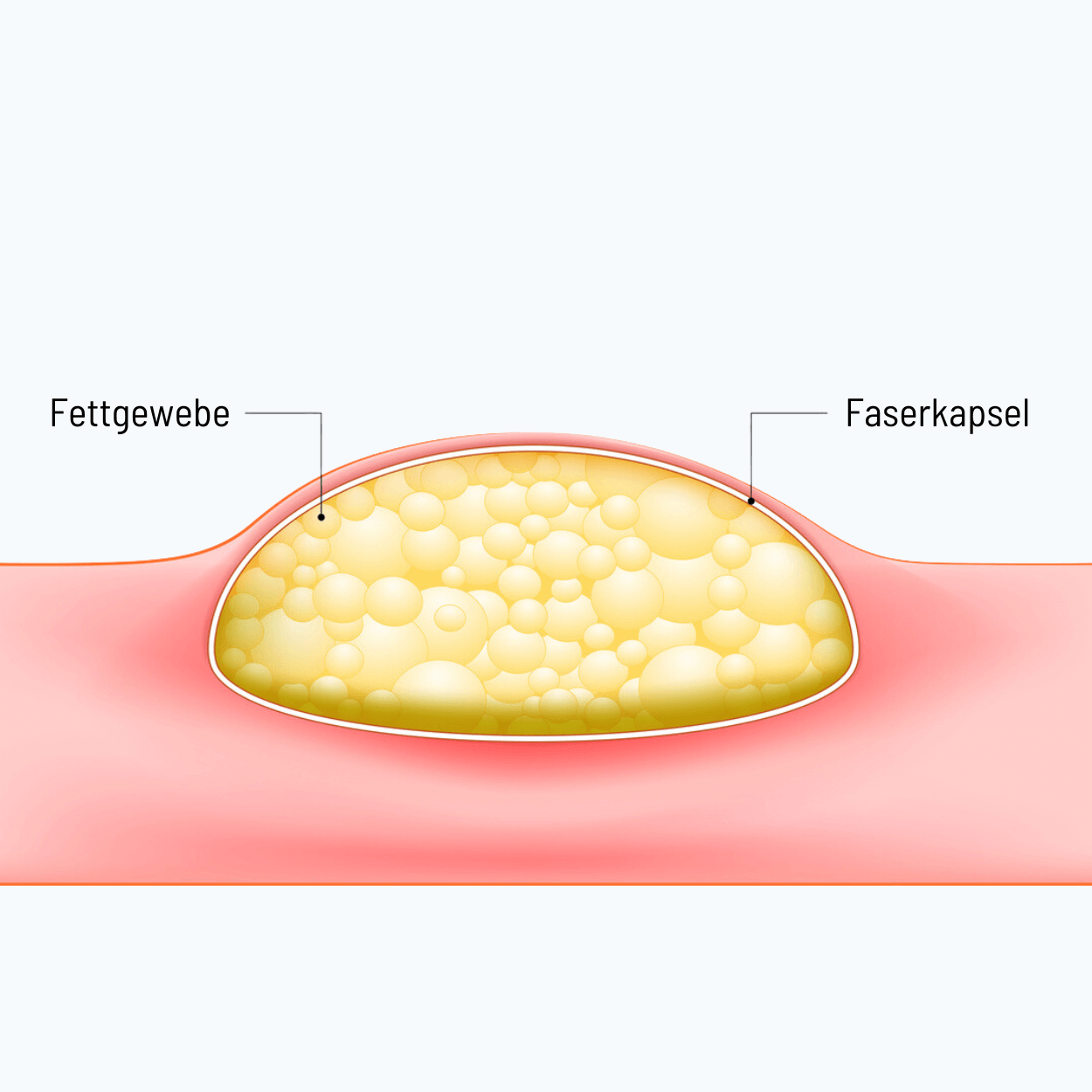 Lipom entfernen in München » Praxisklinik für ambulante Chirurgie